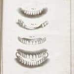 Dentadura postiza: Precio, tipos, cuidado prótesis removible | Clínica ...