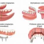Dentadura postiza: Precio, tipos, cuidado prótesis removible | Clínica ...