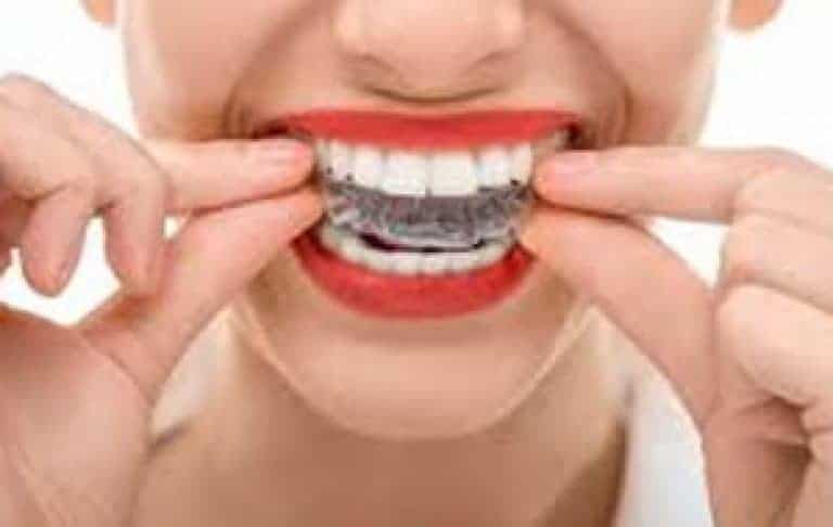 ¿Qué es una férula de descarga? | Clínica Dental en VALENCIA - Benimaclet
