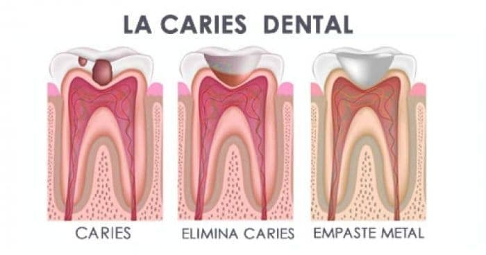 Empaste dental, precio, que es, como se realiza | Clínica Dental en ...