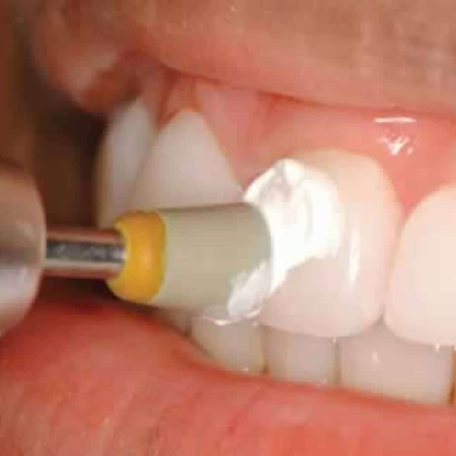 Todo sobre pulido dental | Clínica Dental en VALENCIA - Benimaclet