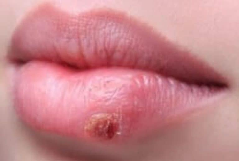 Llagas en la Boca | Clínica Dental en VALENCIA - Benimaclet