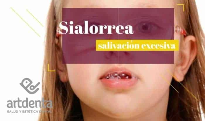 Salivación excesiva o Sialorrea, ¿Qué es? Tratamientos | Clínica Dental ...