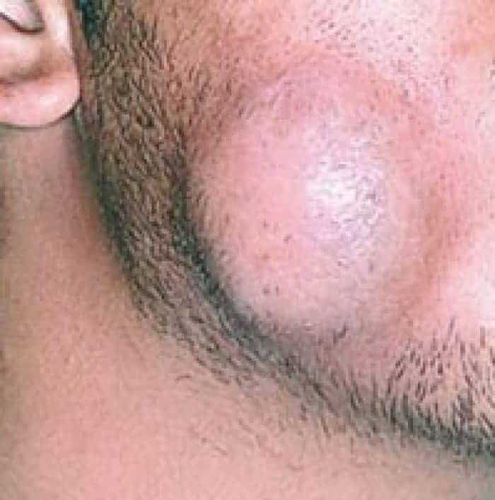 Flemón Dental | Causas, Tratamiento, Complicaciones | Clínica Dental en ...