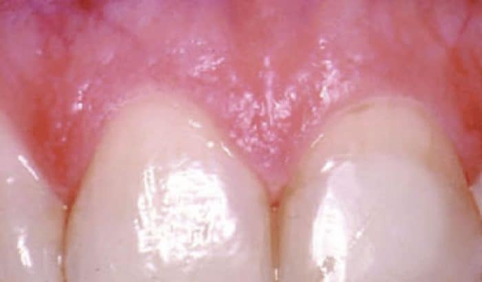 Periodoncia: Precio y tratamiento de periodontitis | Clínica Dental en ...