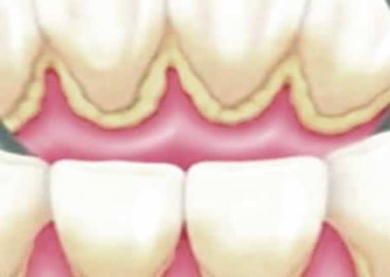 Sarro negro, ¿Qué es? ¿Cómo se forma? | Clínica Dental en VALENCIA ...