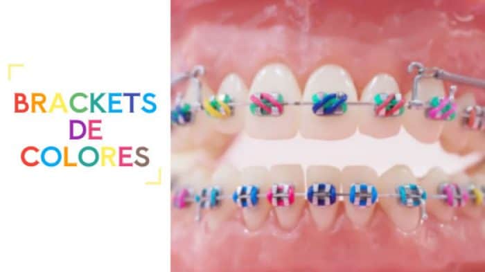 Brackets de colores | Clínica Dental en VALENCIA - Benimaclet