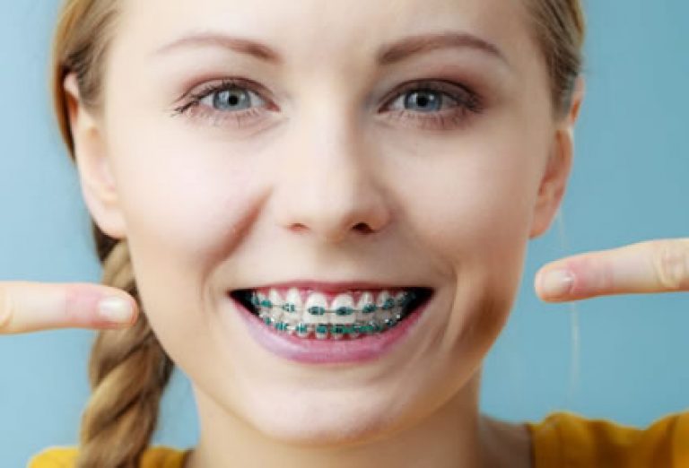 Brackets de colores | Clínica Dental en VALENCIA - Benimaclet