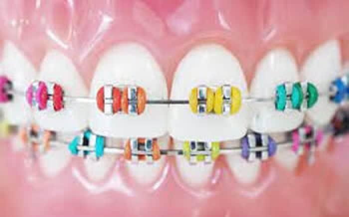 Brackets de colores | Clínica Dental en VALENCIA - Benimaclet