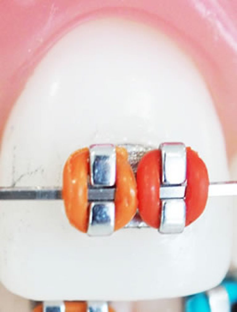 Brackets de colores | Clínica Dental en VALENCIA - Benimaclet