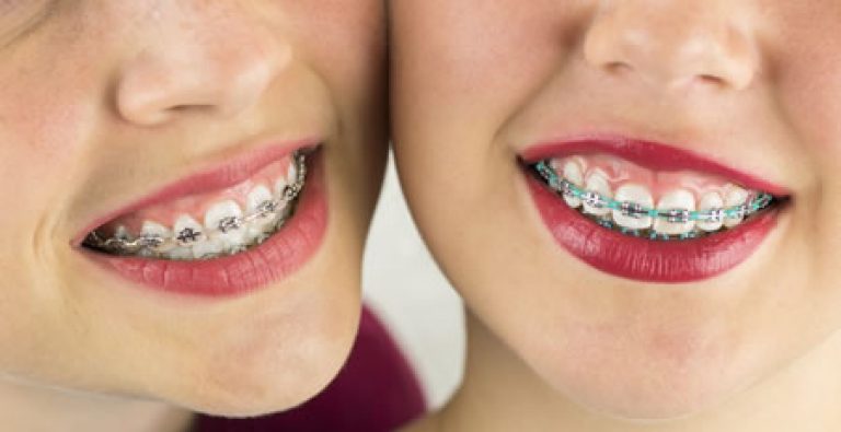 Brackets de colores | Clínica Dental en VALENCIA - Benimaclet