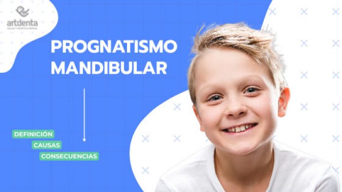 ¿Qué es el Prognatismo Mandibular? Causas. Soluciones | Clínica Dental ...
