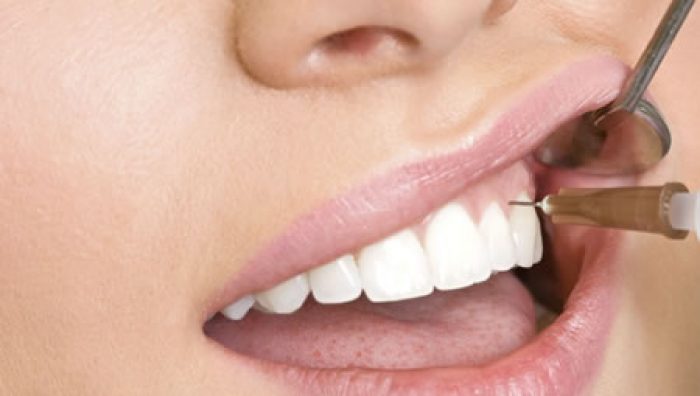 Injerto Dental. ¿Qué es? Operación. Recuperación | Clínica Dental en ...