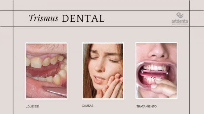 ¿Qué es el Trismus dental? Diagnóstico. Tratamiento. | Clínica Dental en VALENCIA - Benimaclet