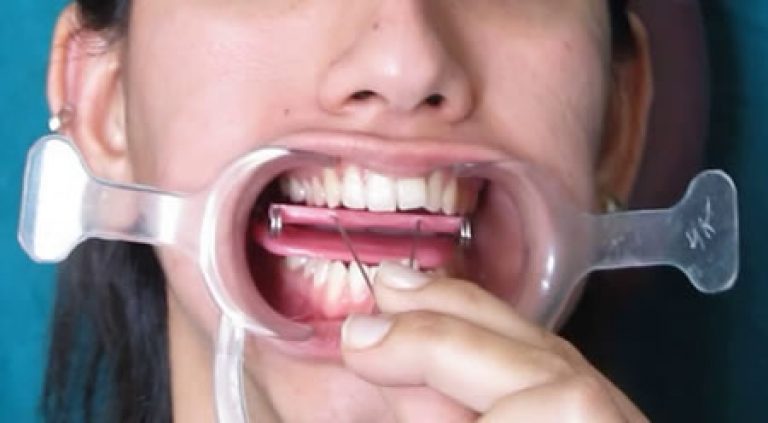 ¿Qué es el Trismus dental? Diagnóstico. Tratamiento. | Clínica Dental ...