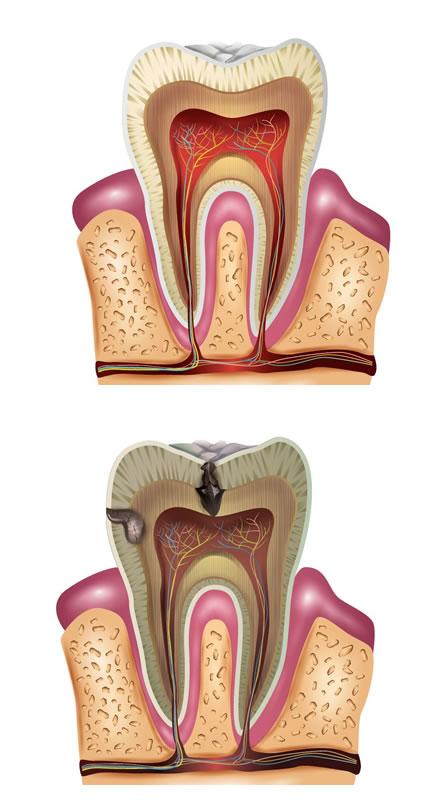 ¿Qué es un Perno Dental? Colocación. Tipos de Pernos. | Clínica Dental ... ¿Qué es un Perno Dental? Colocación. Tipos de Pernos. | Clínica Dental ...