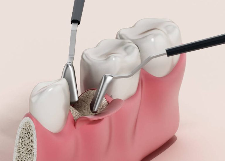 Injerto Óseo en Implantes: Por Qué es Necesario | Clínica Dental en ...